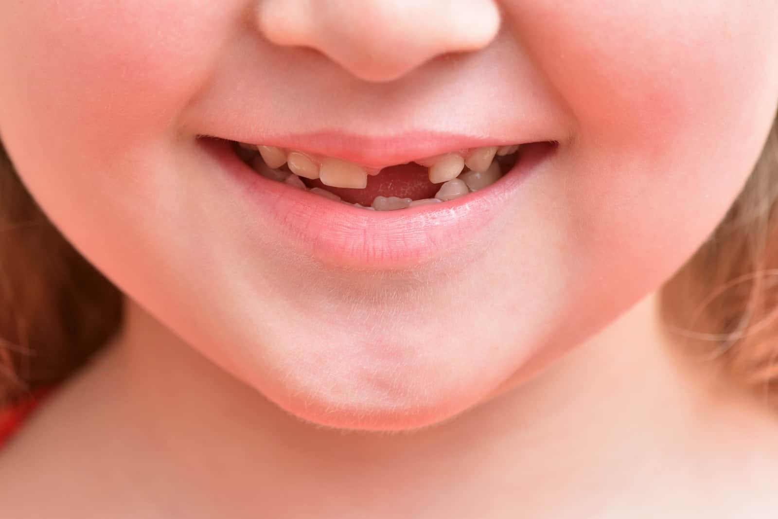 Adult Baby Teeth Replacement With Dental Implants